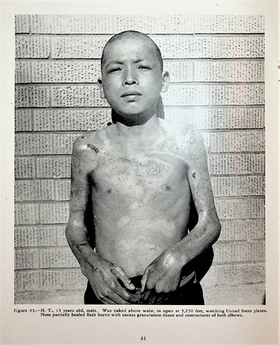 The Effects of Atomic Bombs on Health and Medical Services in Hiroshima ...